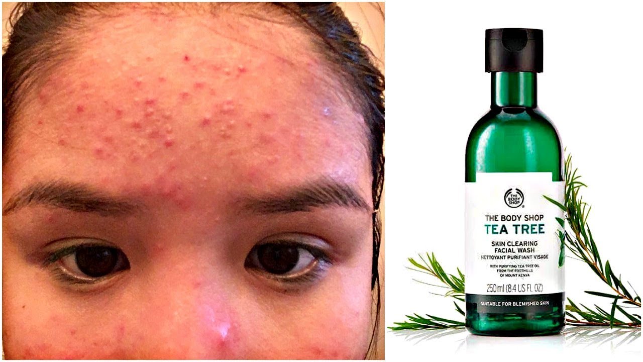 TEA TREE OIL RUINED MY FACE & How I Cleared it Back Up - Cleansing ...
